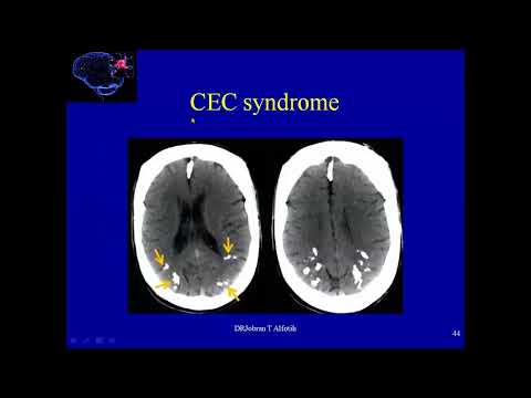 Brain Talk: it is Calcification NOT hematoma.!!