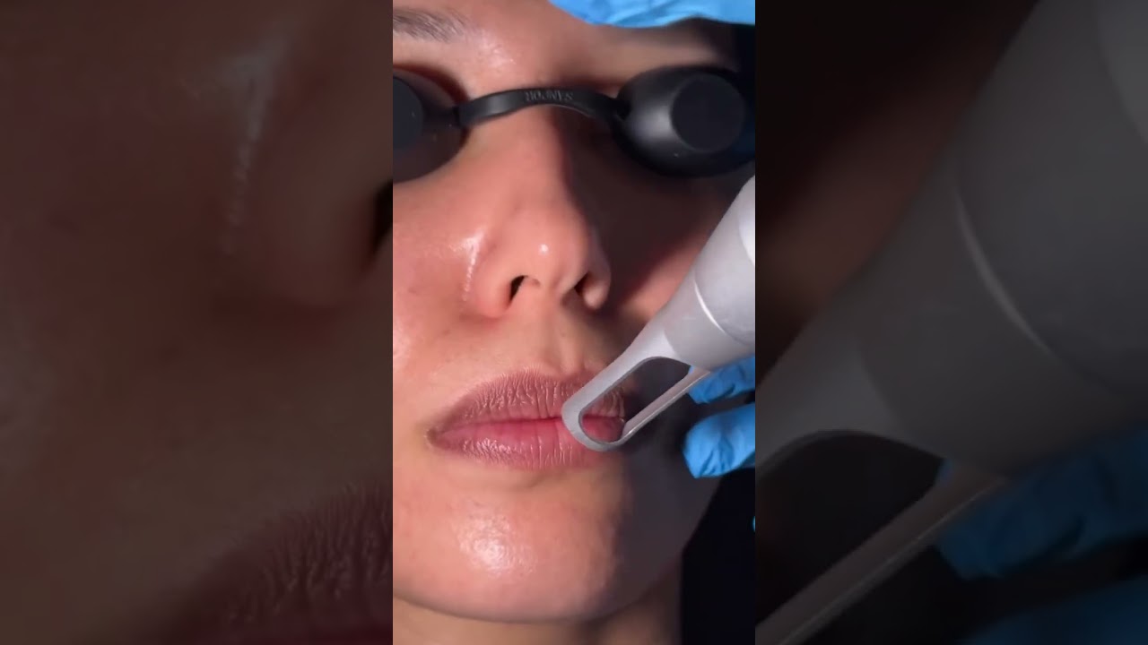 Pico lip laser#amazing #lip care#amazing results #viral shorts # beautiful lips
