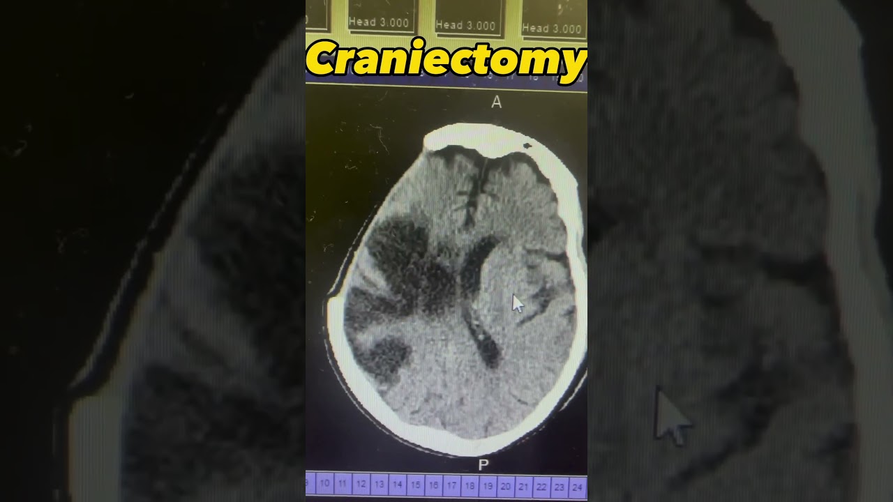 #Cranioplasty #Craniectomy #Stroke #Brain #Injury #Recovery #Medical #Health #Wellness #neurosurgeon