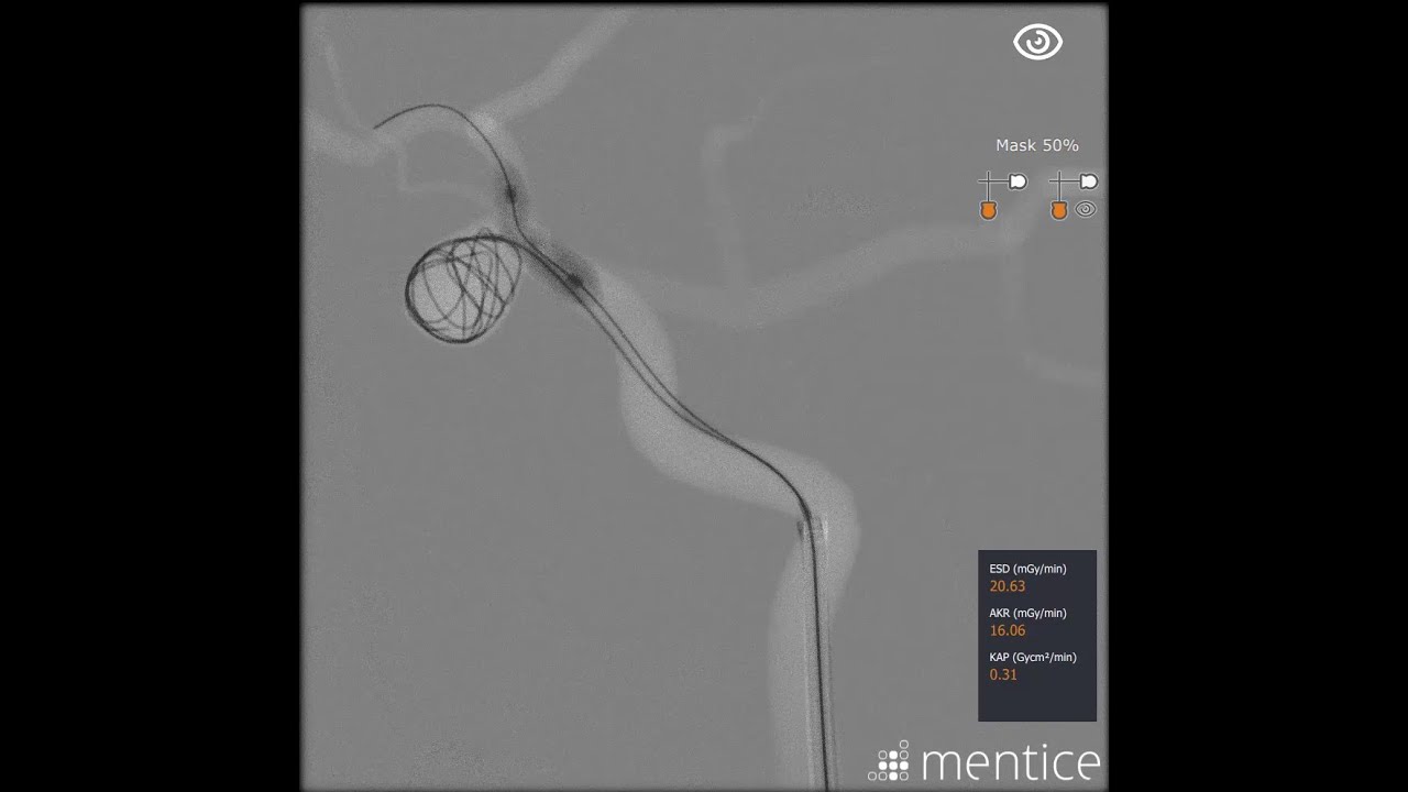 Mentice Neurovascular Brain Aneurysm Coiling Demo