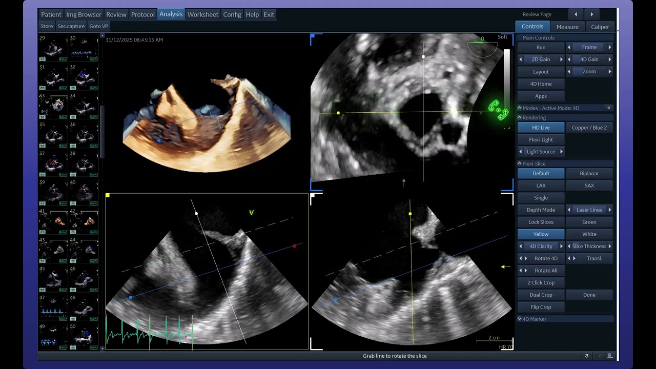 Left Atrial Appendage Sizing and 3D Echocardiography