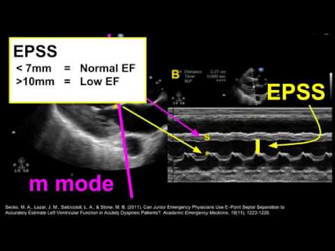EPSS- Cardiac Ultrasound – EM in 5