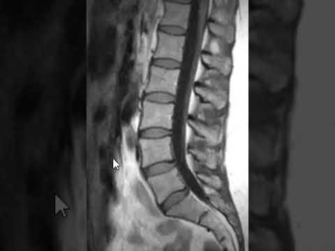 facet arthritis