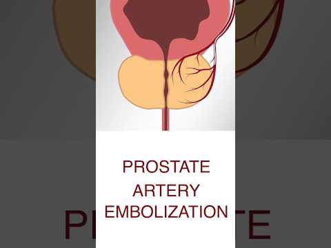 What is Prostate Artery Embolization - Dr Arpit Taunk| Apollo Hospital Lucknow