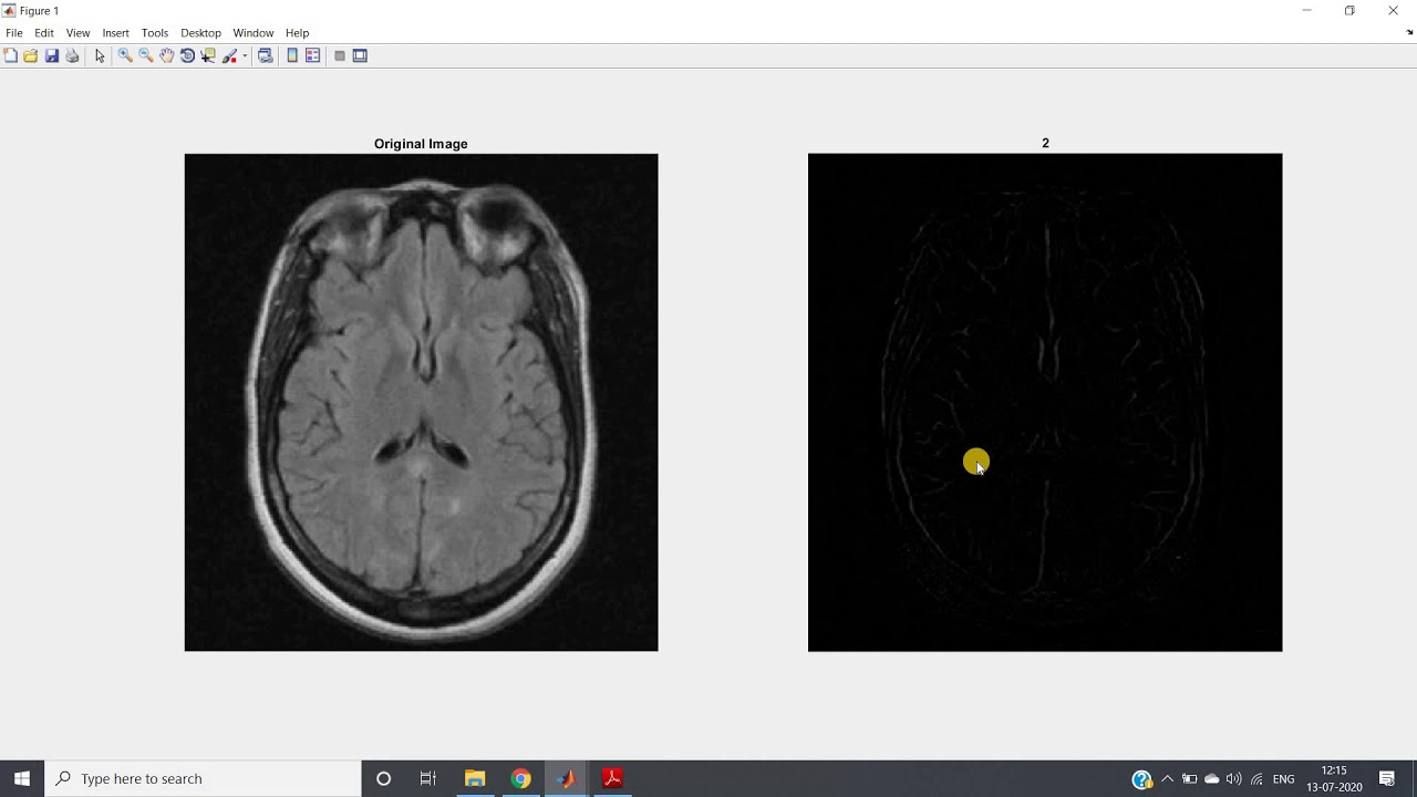 Black Top-Hat Transform on MRI Image | Digital Image Processing | MATLAB