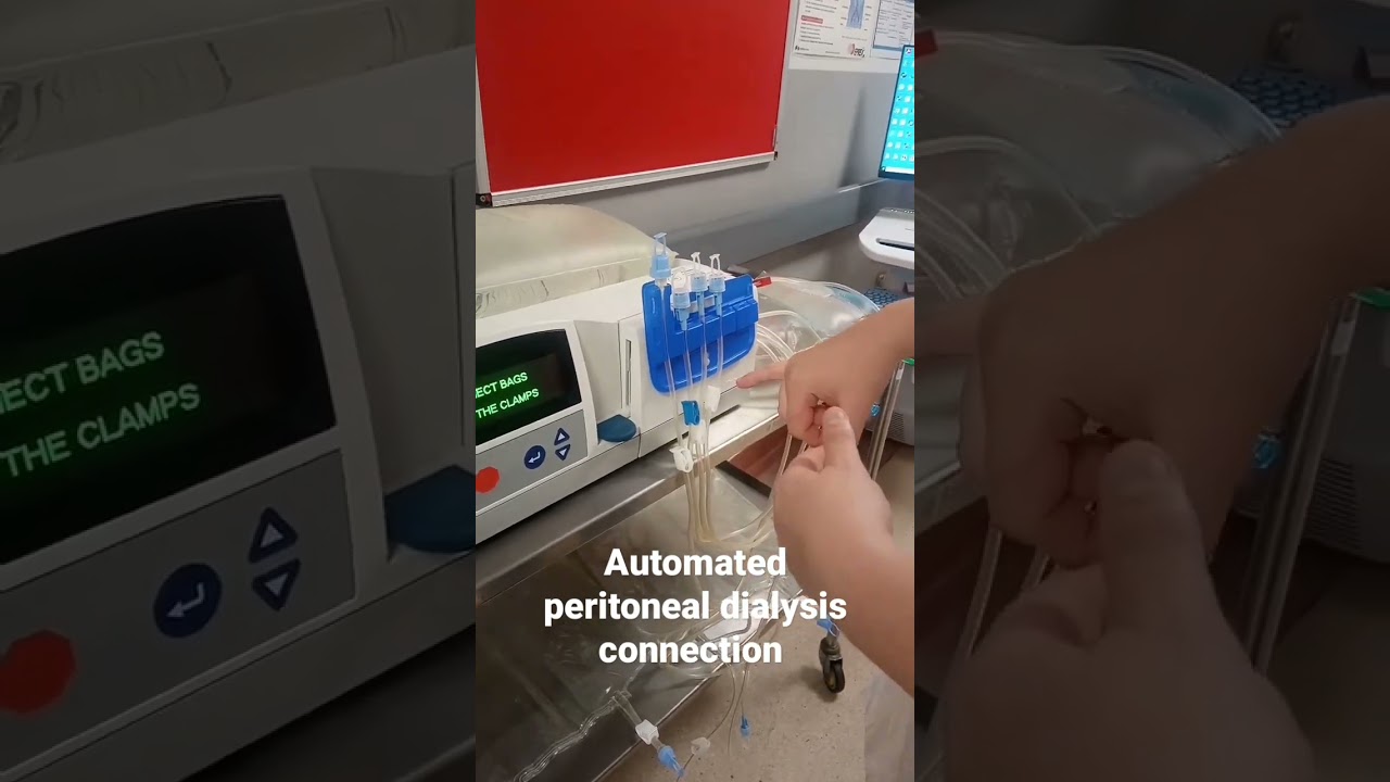Automated peritoneal dialysis machine connection #worldkidneyday