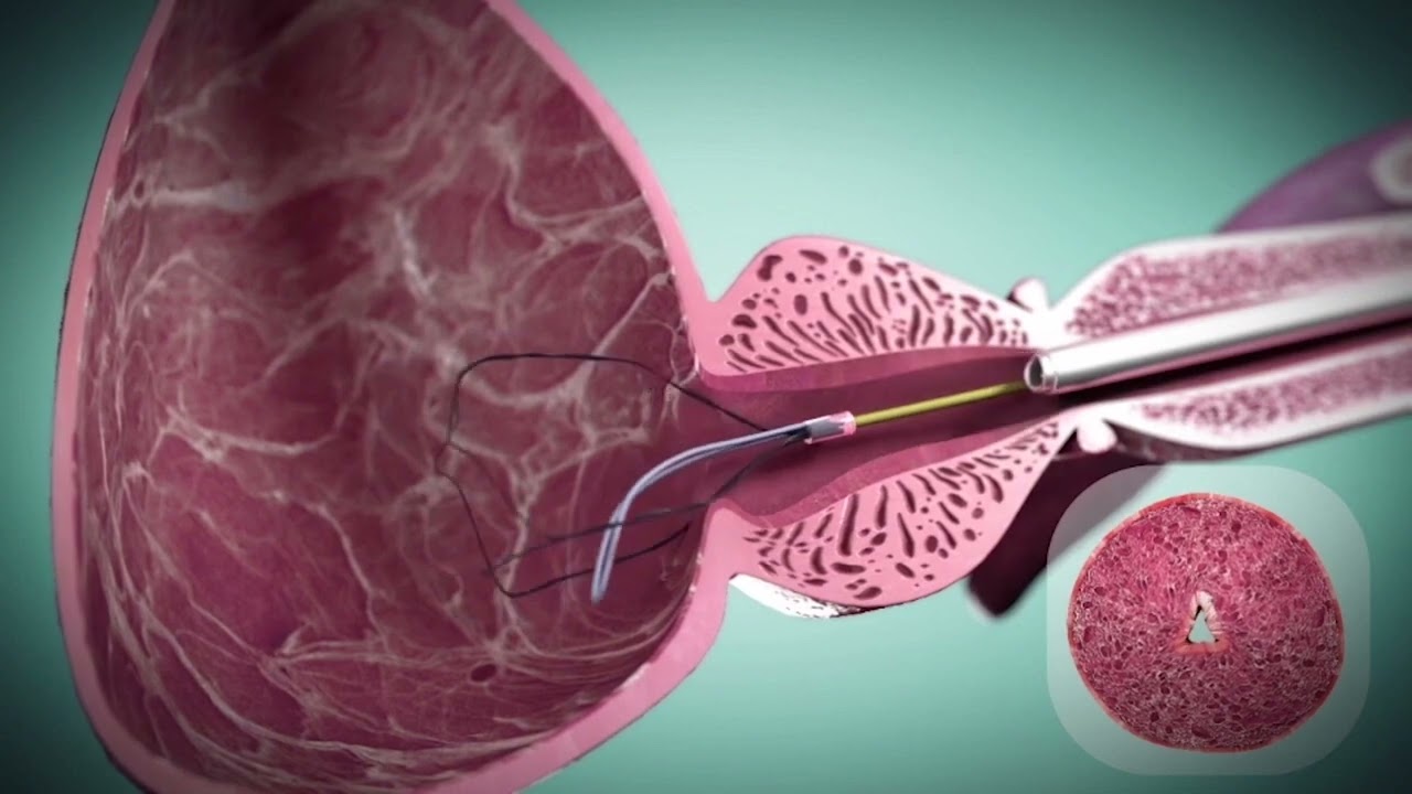 The iTind™ Procedure