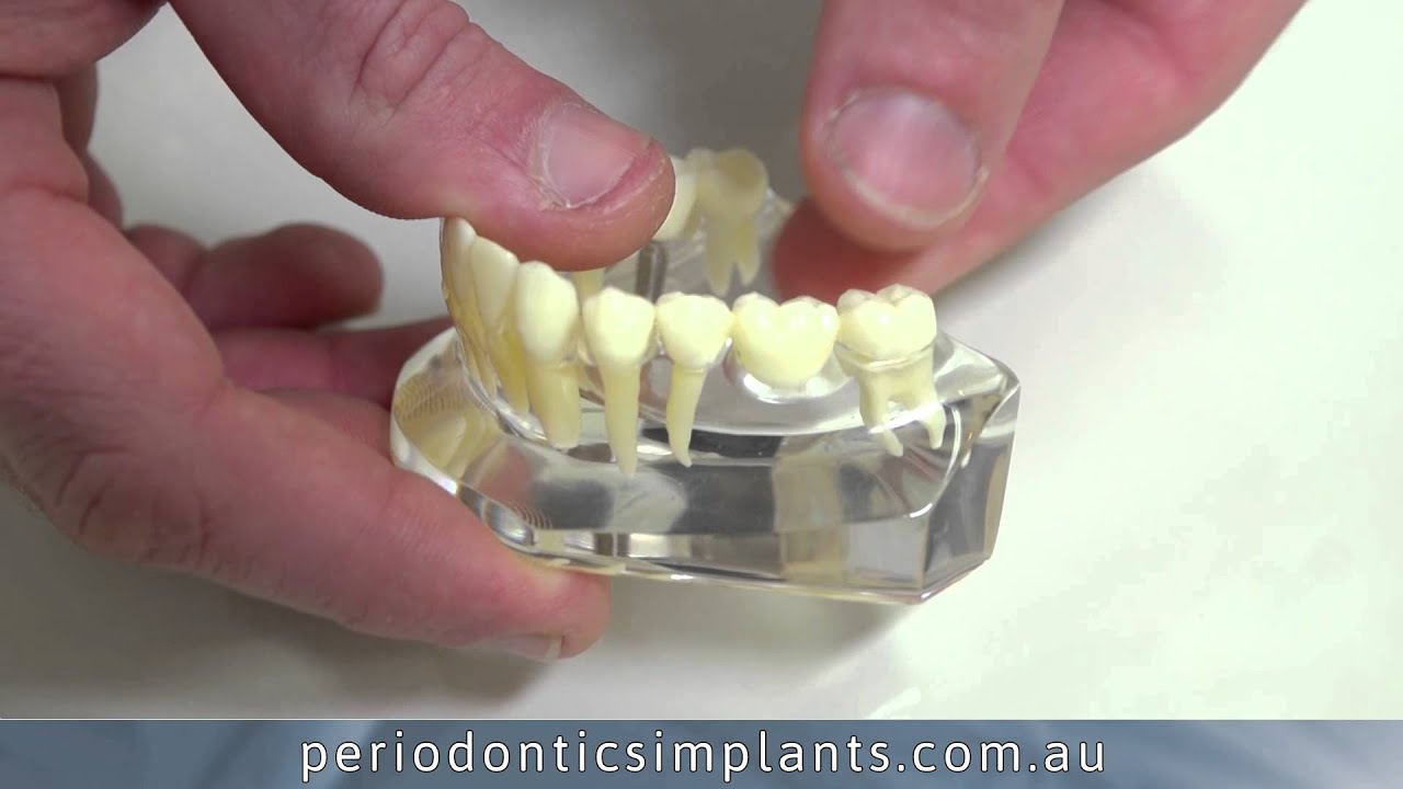 What are my options for replacing multiple missing teeth?