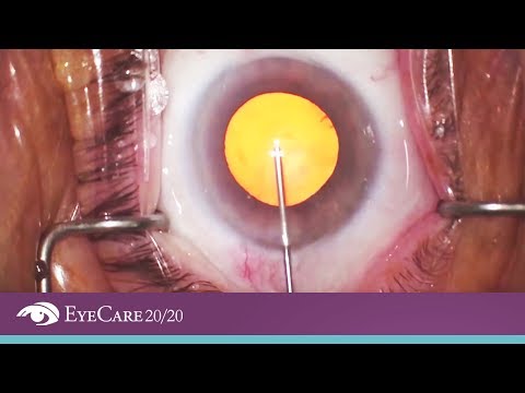 Standard cataract surgery