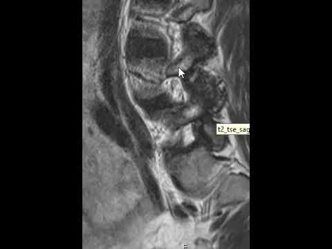 Facet arthritis and disc herniation
