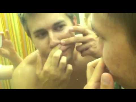 Owned that hard-to-get-at-nose pimple