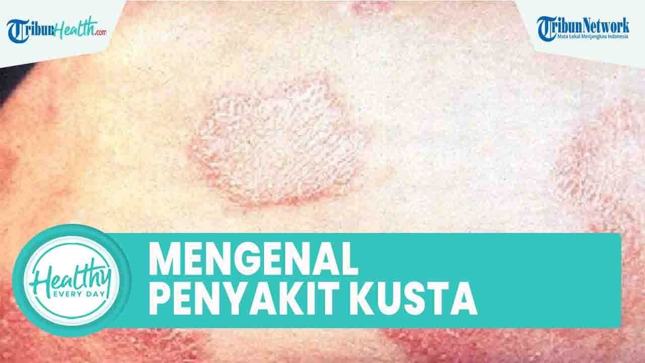 Mengenal Penyakit Kusta yang Dapat Rusak Saraf, Ini Gejala & Penyebab ...