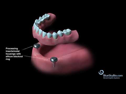 Overdenture Chairside Technique