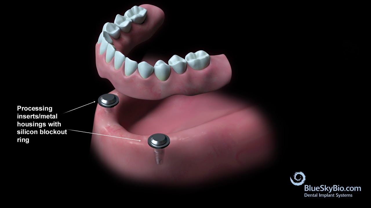 Overdenture Chairside Technique