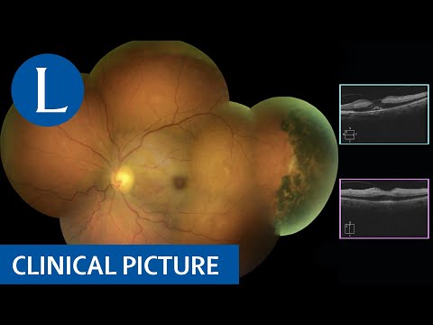Central retinal artery occlusion in sickle cell anaemia