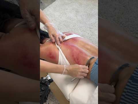 Strange Toxins Came out of Her Back 👀 CRUNCHY #chiropractic #guasha #asmr #shorts