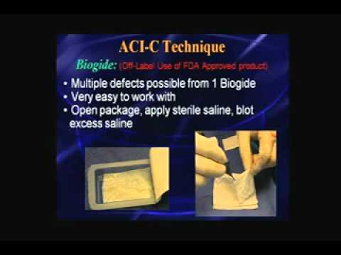 Autologous Chondrocyte Implantation - Gillogly, WOSM