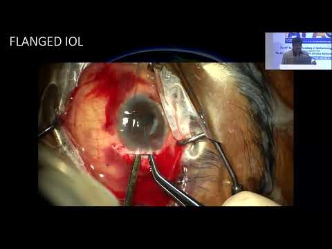 AIOS2025 IC142 T Dr M RAVISHANKAR Flanged IOL & Yamane Technique