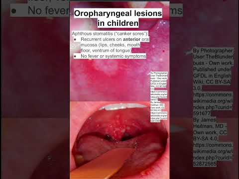 Oropharyngeal lesions in children