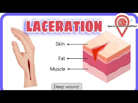 LACERATION @SportsScienceSimplifed