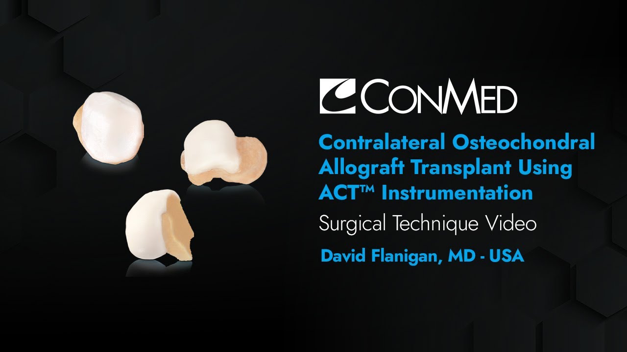 Contralateral OC Allograft Transplant Using ACT™ Instrumentation - David Flanigan, MD - Technique