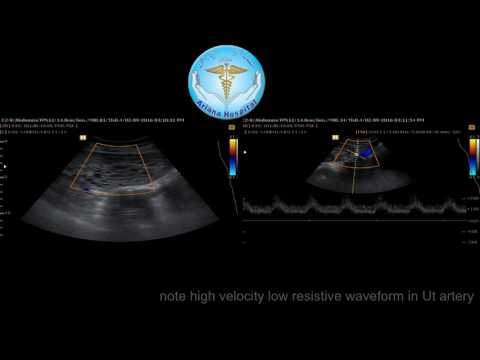 MOLAR PREGNANCY on Doppler Ultrasound by Dr. Hedayatullah Lalzai