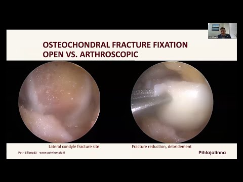 Inion Webinar: Dr. Petri Sillanpää - OCD and Osteochondral Fractures in the Knee