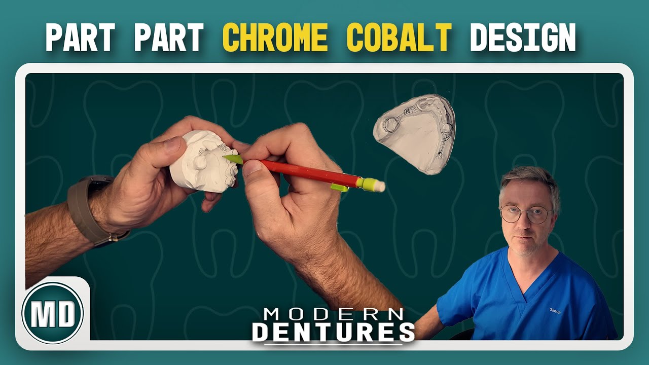 Designing a Part-Partial Chrome Cobalt Denture (How I Do It) | Modern Dentures