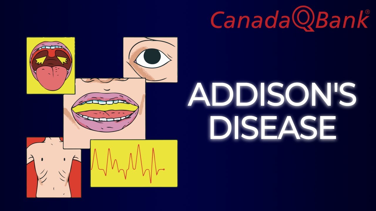 Addison Disease Explained | Primary Adrenal Insufficiency, Diagnosis & Treatment | CanadaQBank