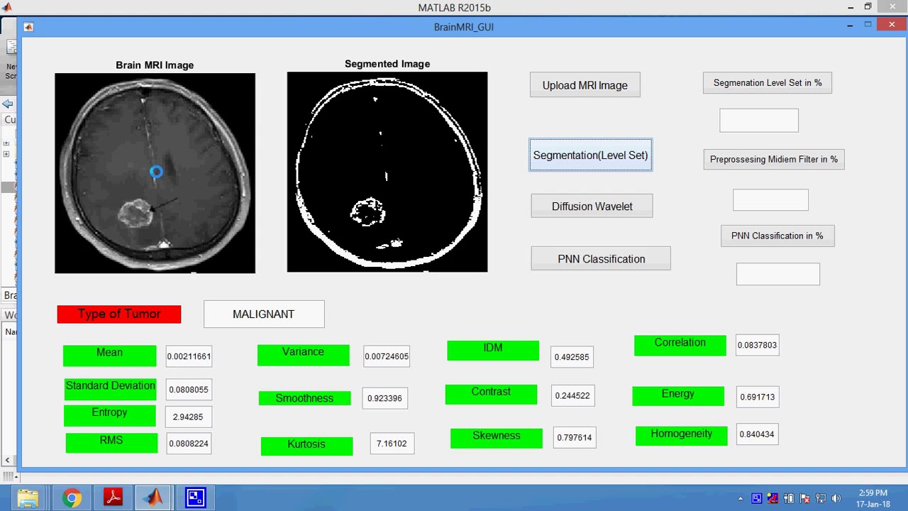Brain Metastases Detection Methods in Magnetic Resonance Imaging in ...