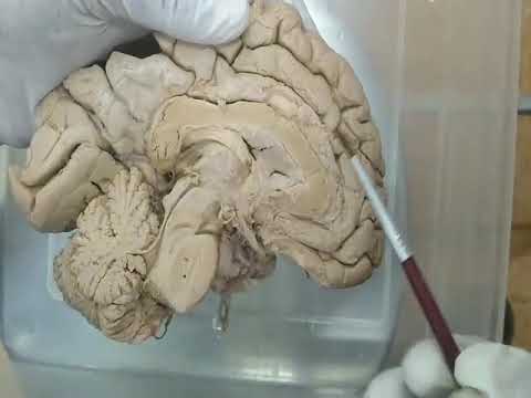 Medial surface of brain specimen