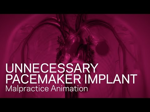 Pacemaker - Medical Device Animation