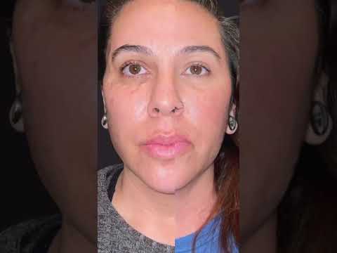 I Tried the Viral Treatment for a Youthful Appearance