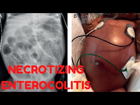 NECROTIZING ENTEROCOLITIS : What is Necrotizing Enterocolitis? : Necrotizing Enterocolitis Symptoms