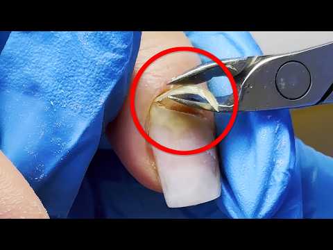 How to Fix a Nail with Paronychia: Step-by-Step Treatment 💅🦠