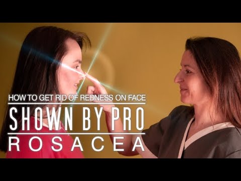 How to get rid of redness on face | Rosacea | Shown by PRO