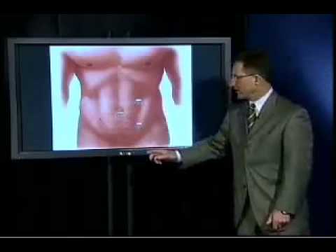 Acute Appendicitis: The Case for Laparoscopic Appendectomy and Laparoscopic Appendectomy Technique