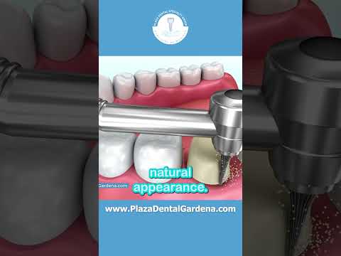 Types of Dental Crowns and Their Uses