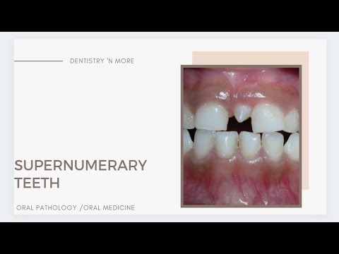 SUPERNUMERARY TEETH