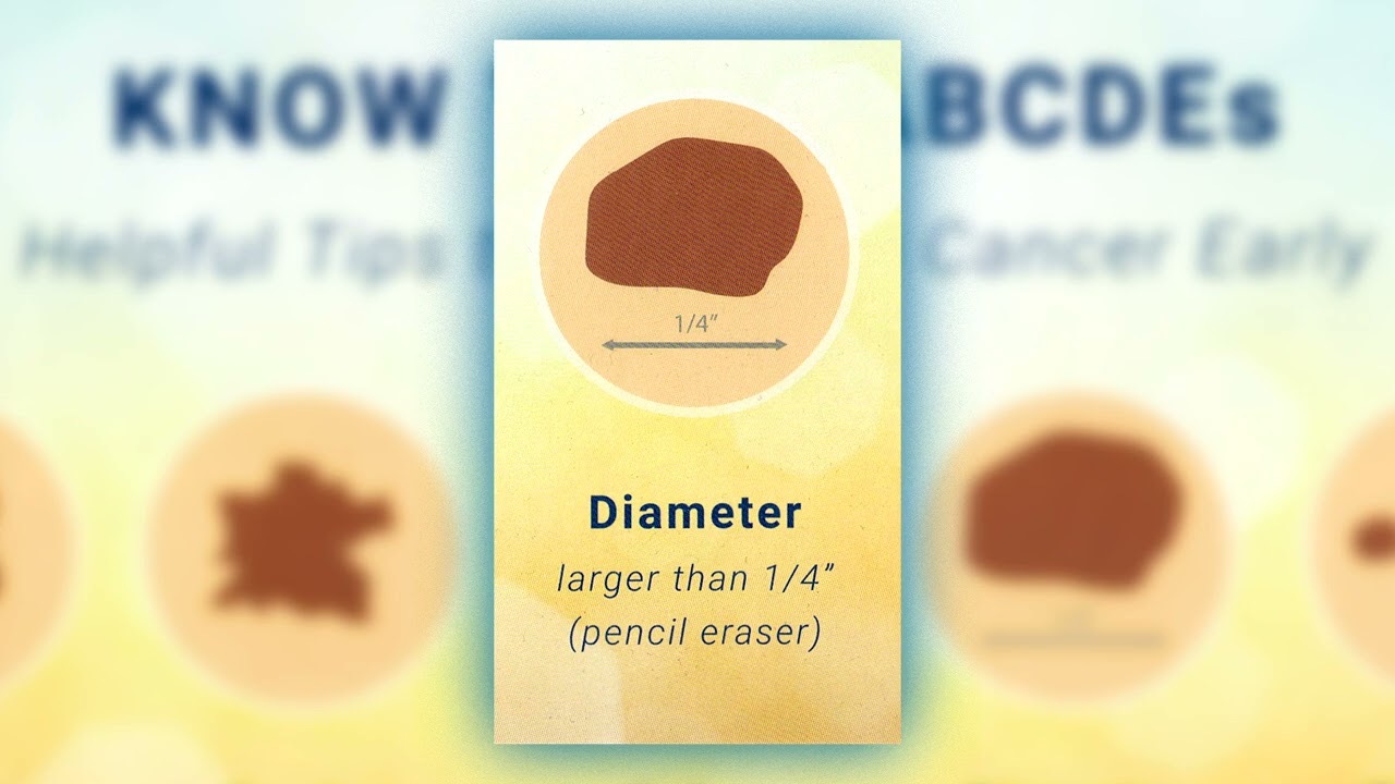Understanding the ABCDEs of Melanoma with Darren West | Pinnacle Dermatology