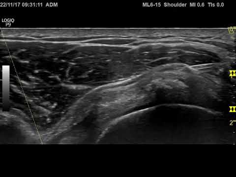 Subacromial bursa inejction