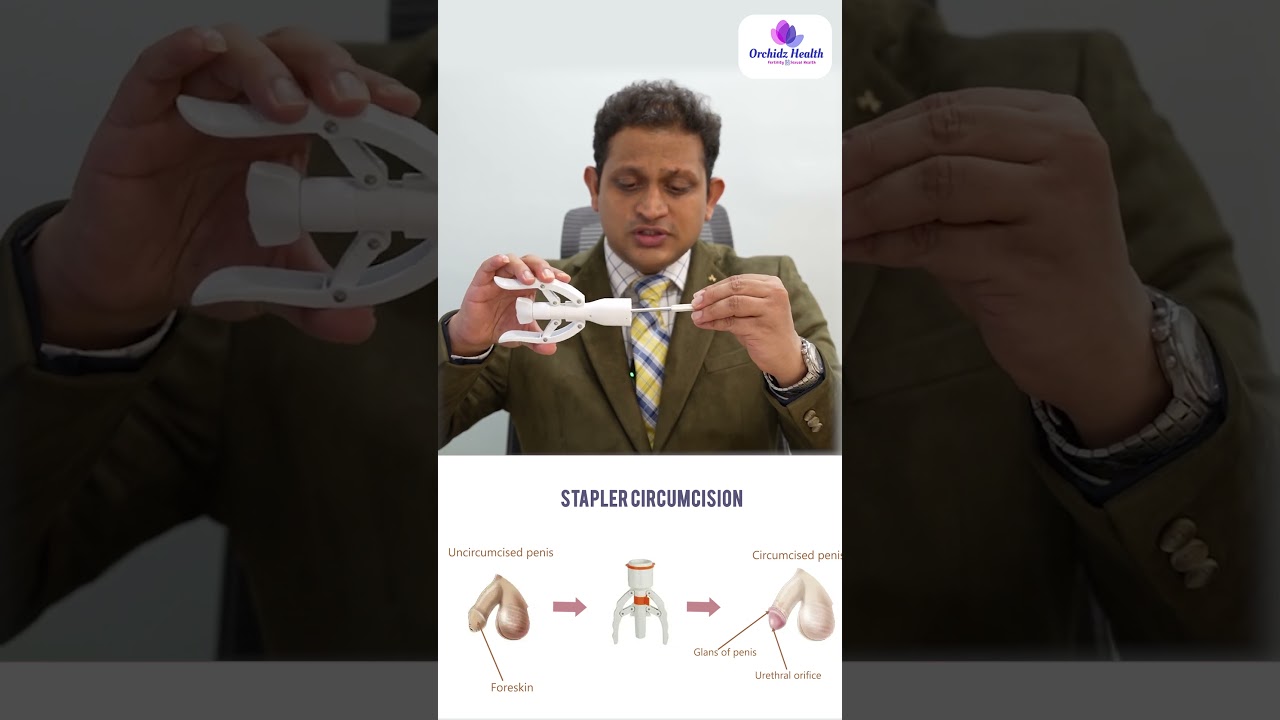 Stapler Circumcision #andrologist #doctor #urologist