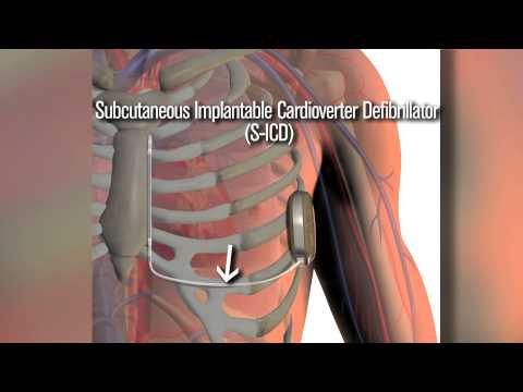 New S-ICD defibrillator a safety net for cardiac patients