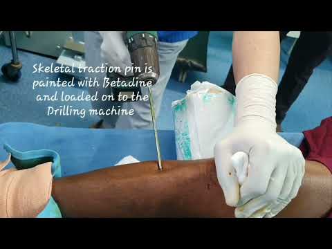 Skeletal traction high Tibial | IT fracture femur in a Co-morbid, Osteoporotic | Local Anae | Adamya