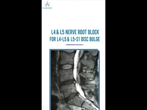 Nerve Root Block | Non Surgical Treatment for Back Pain