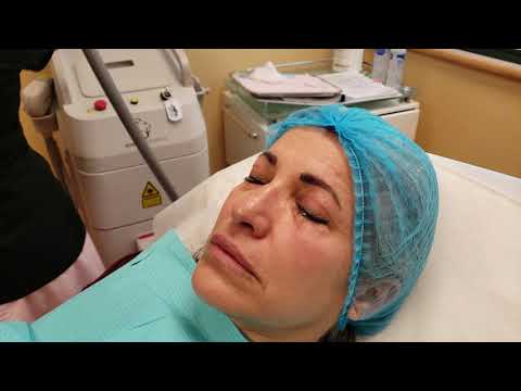 Eyeliner laser removal | Laser removal of permanent makeup eyeliner