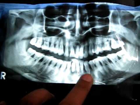 Partial Fracture Of Mandible