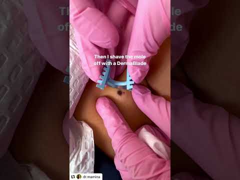 Mole Removal