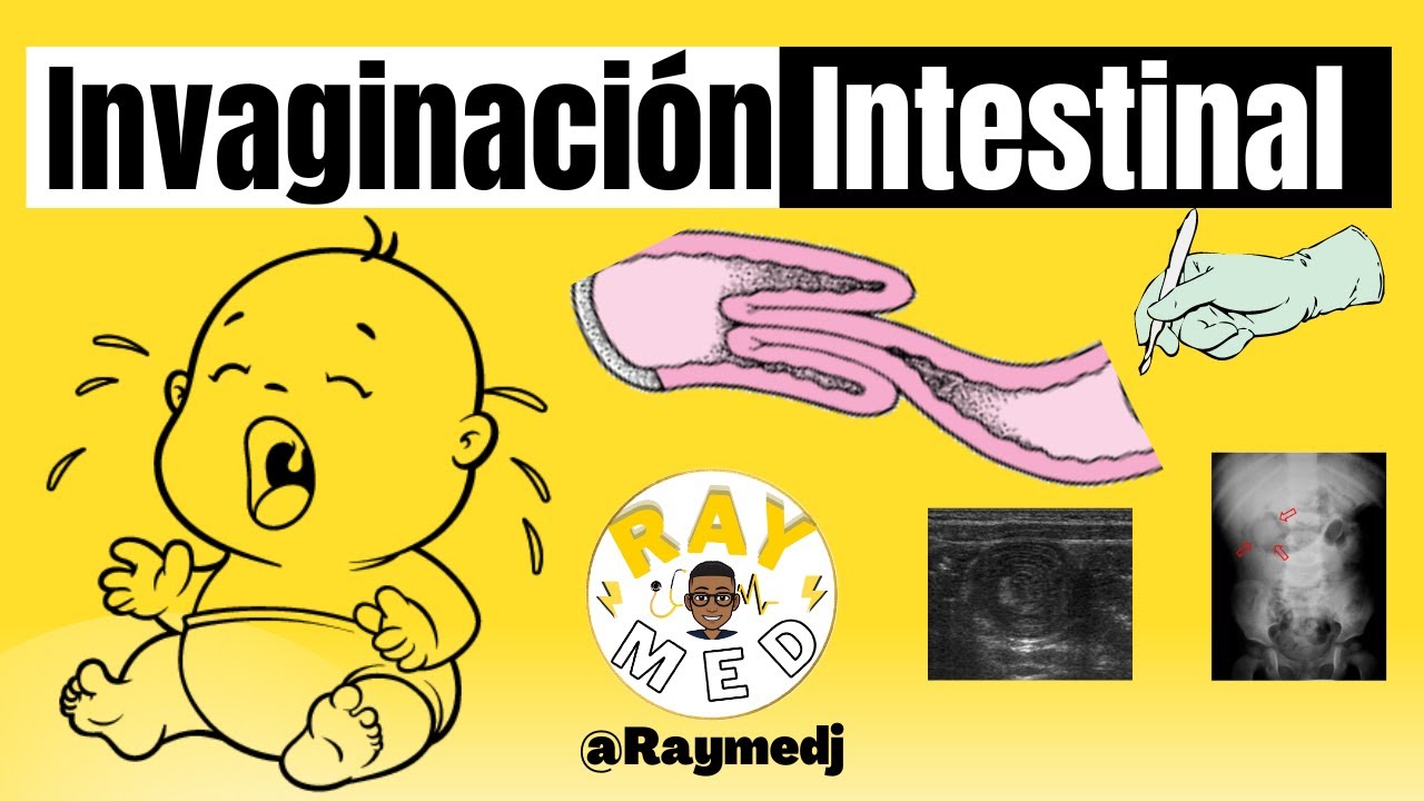 INVAGINACIÓN INTESTINAL, Explicada en 9 MINUTOS!