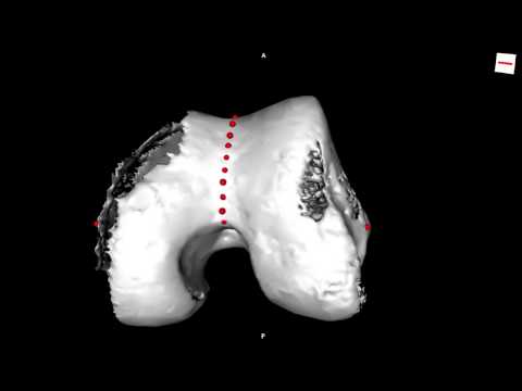 Sulcus Line of the trochlear groove is more accurate then Whiteside's Line